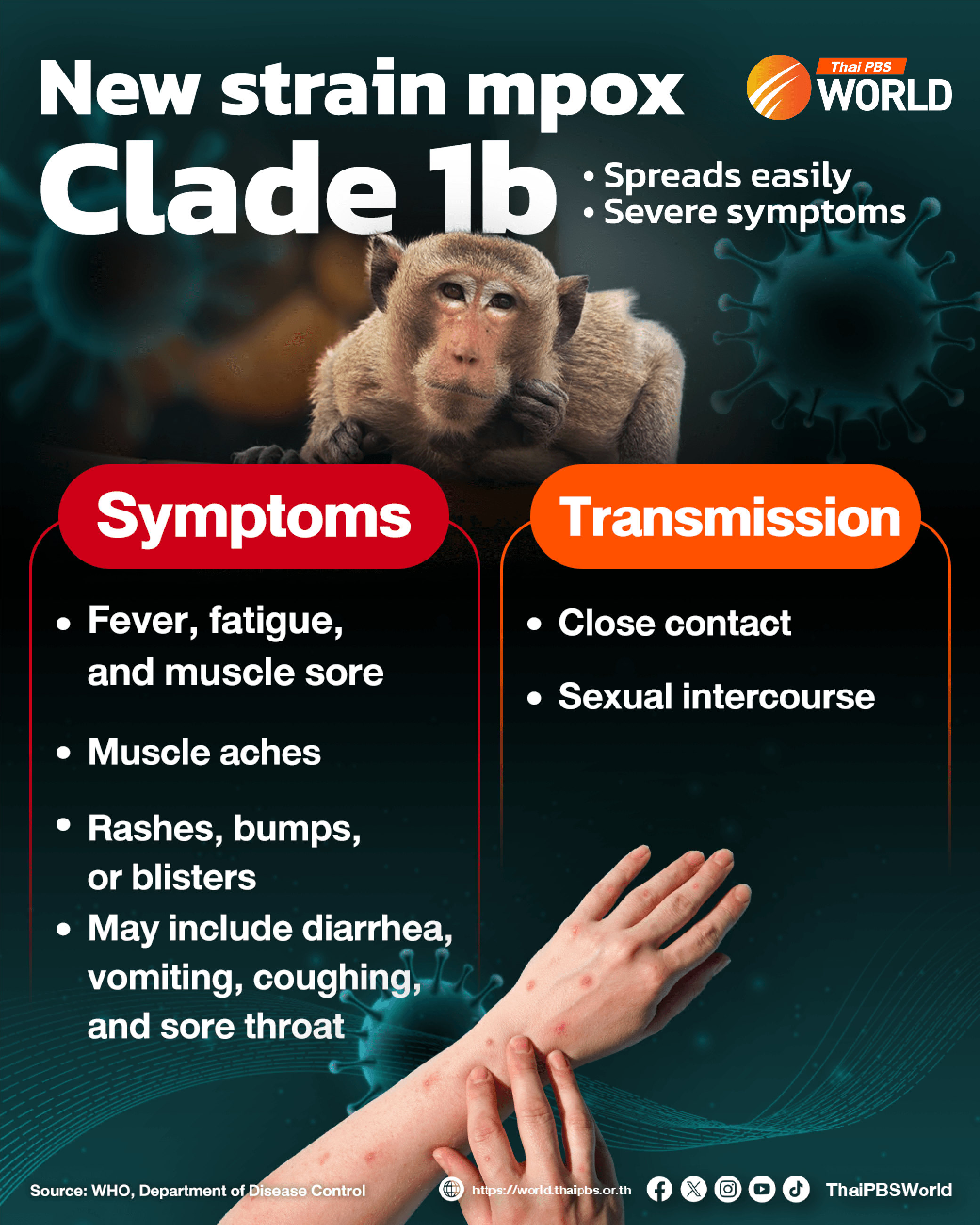 New strain mpox: Clade 1b